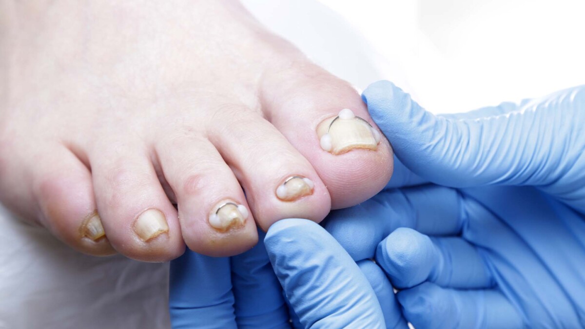 Wrastające paznokcie - Bosa Stopa